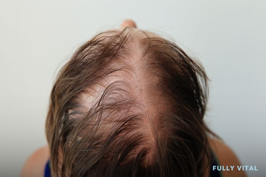 Anagen Effluvium: Understanding Hair Loss And Solutions | FullyVital