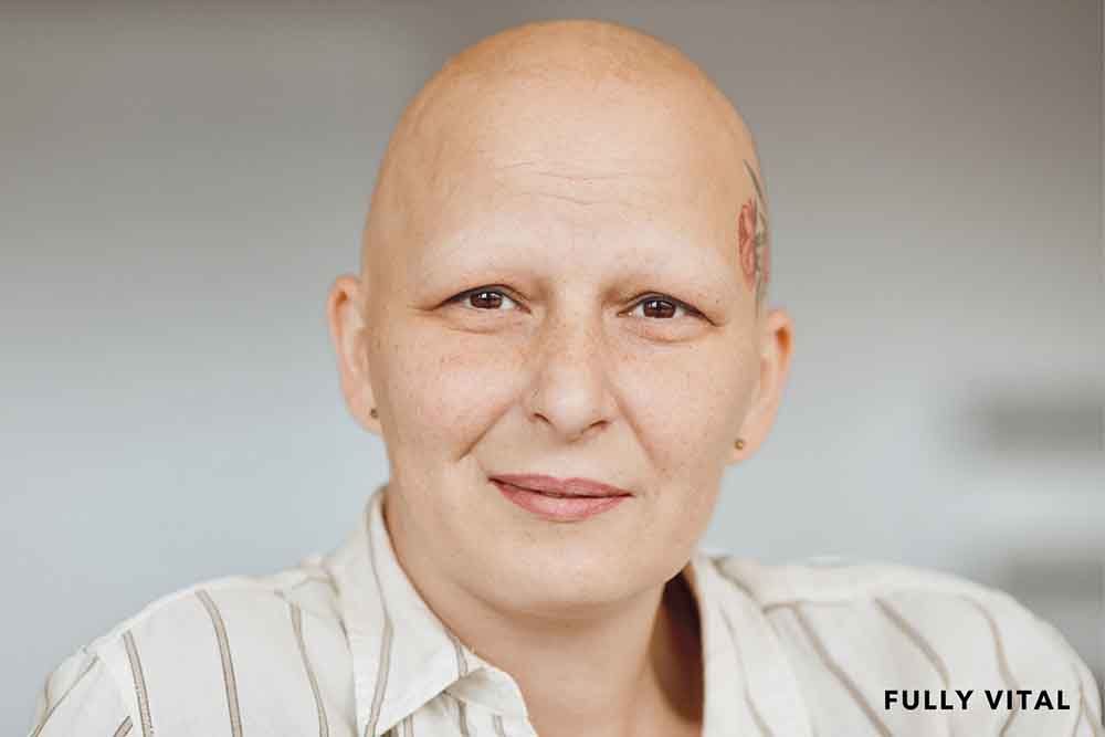 Alopecia Universalis: Understanding and Managing this Condition