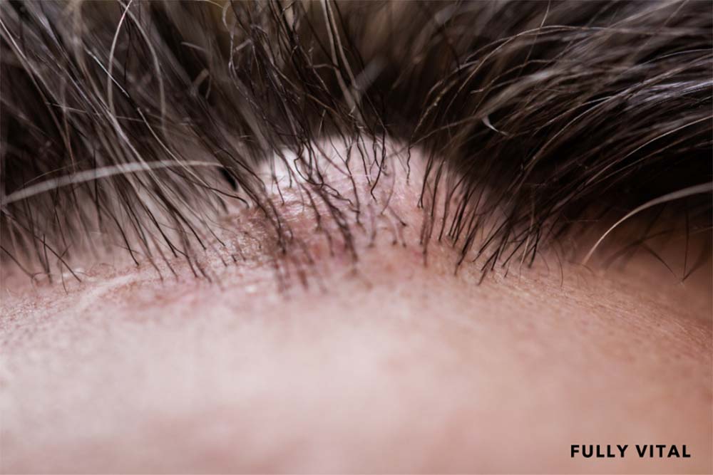 Unlocking The Secrets Of Pilar Cysts For Healthier Hair Growth | FullyVital