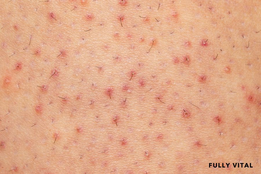 Folliculitis: Causes, Risks, And Treatment | FullyVital
