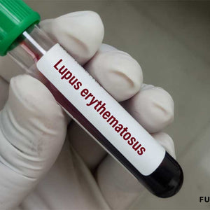 Systemic Lupus Erythematosus: Understanding The Connection To Hair ...