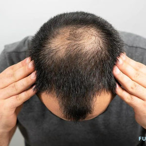 Uneven Hairline: Understanding And Preventing Hair Loss | FullyVital
