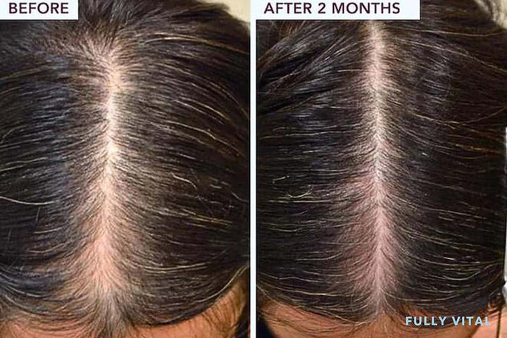 Derma Roller Before and After: Unlocking the Potential for Hair Growth ...