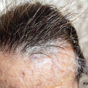 Trichomycosis: Unveiling The Hair Health Mystery | FullyVital