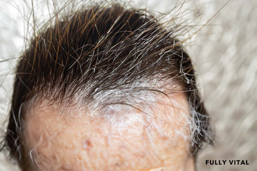 Trichomycosis: Unveiling The Hair Health Mystery | FullyVital